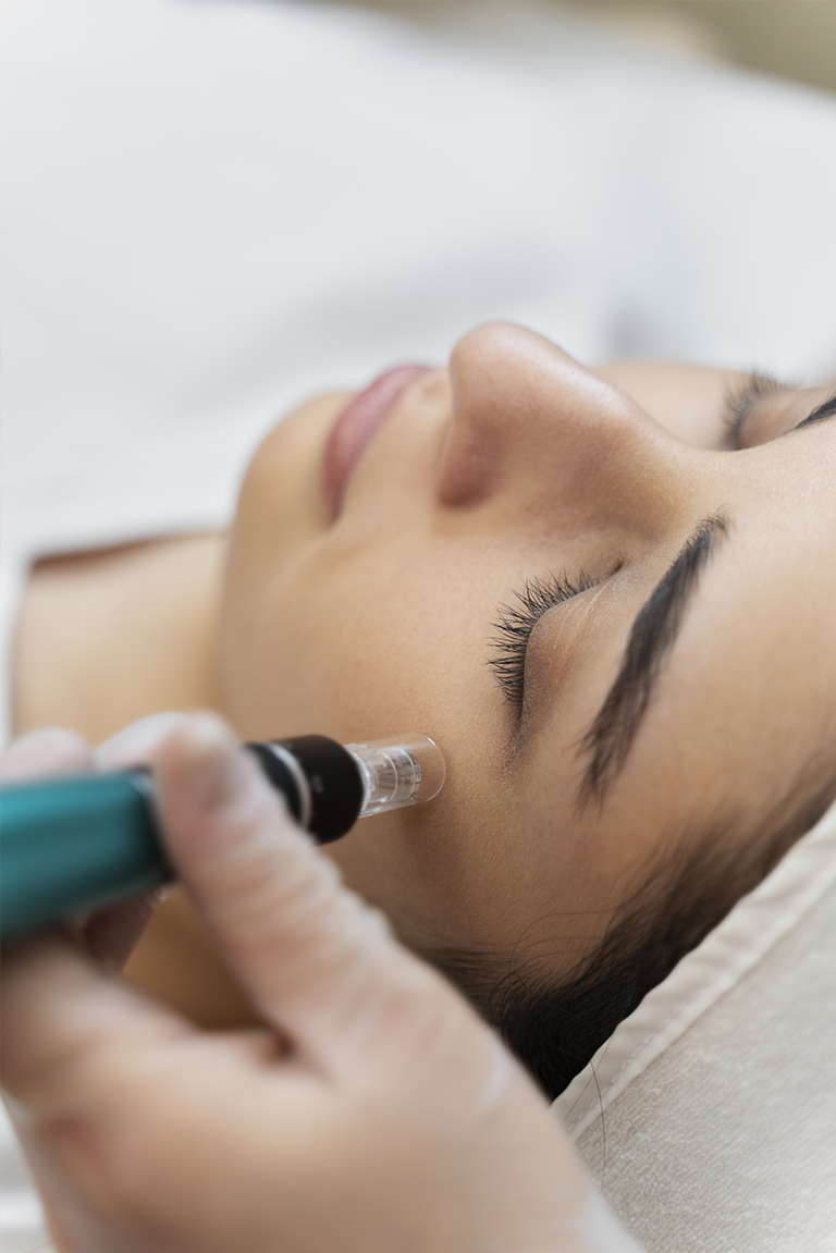 Micro-needling RF - Fine Skin Care Clinic Toronto - Advanced Skin ...