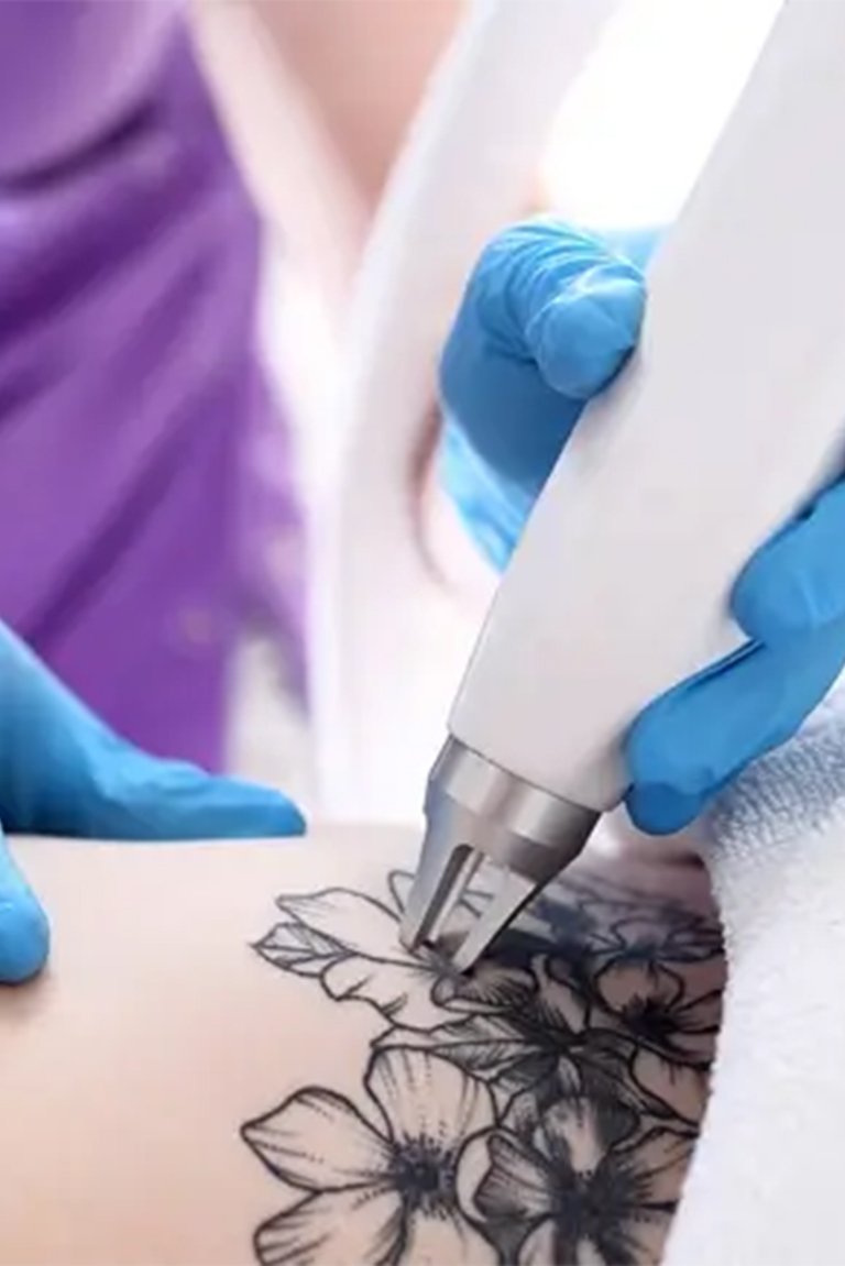 Safe & Effective Tattoo Removal in Toronto - Fine Skin Care